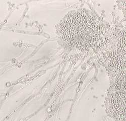 Vaginal Candidiasis Microscopy